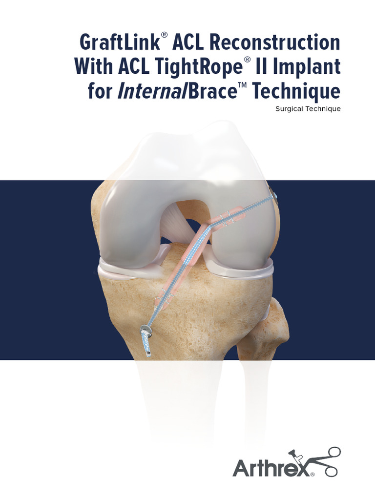 Graftlink Acl Reconstruction With Acl Tightrope II Implant For Internalbrace Technique | PDF ...