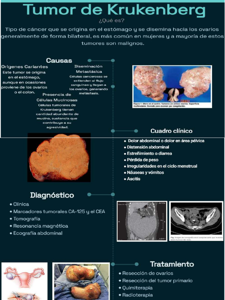Tumor de Krukenberg | PDF