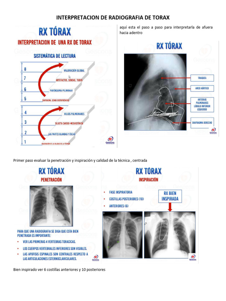 Interpretacion de Radiografia de Torax | PDF