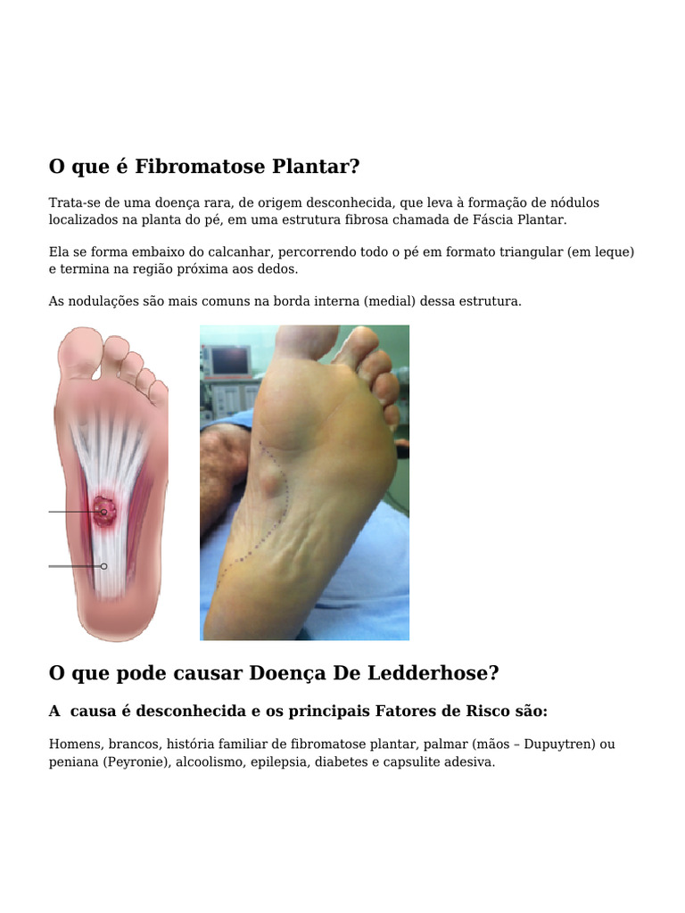 Fibromatose Plantar (Doença de Ledderhose) Saiba Tudo | PDF | Ciências ...