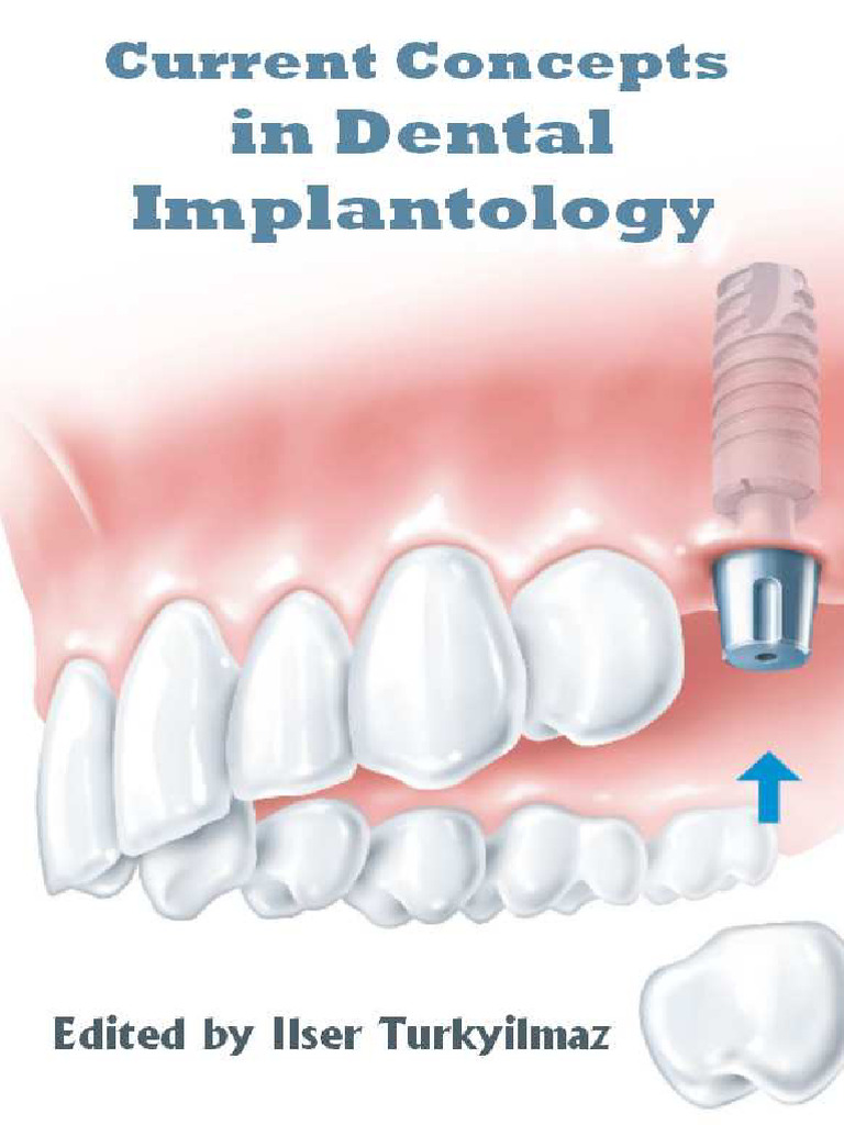 Current Concepts in Dental Implantology | PDF | Dental Implant | Dentistry