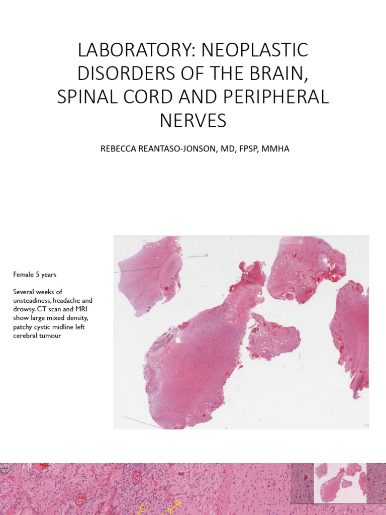 SC Neoplastic Disorders of The Brain Spinal Cord and Peripheral Nerves ...