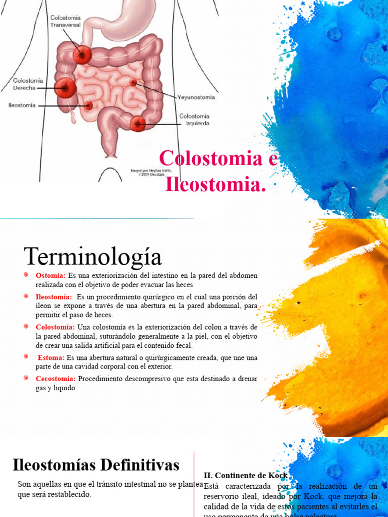 Tipos de Colostomía e Ileostomía | PDF | Intestino grueso | Abdomen