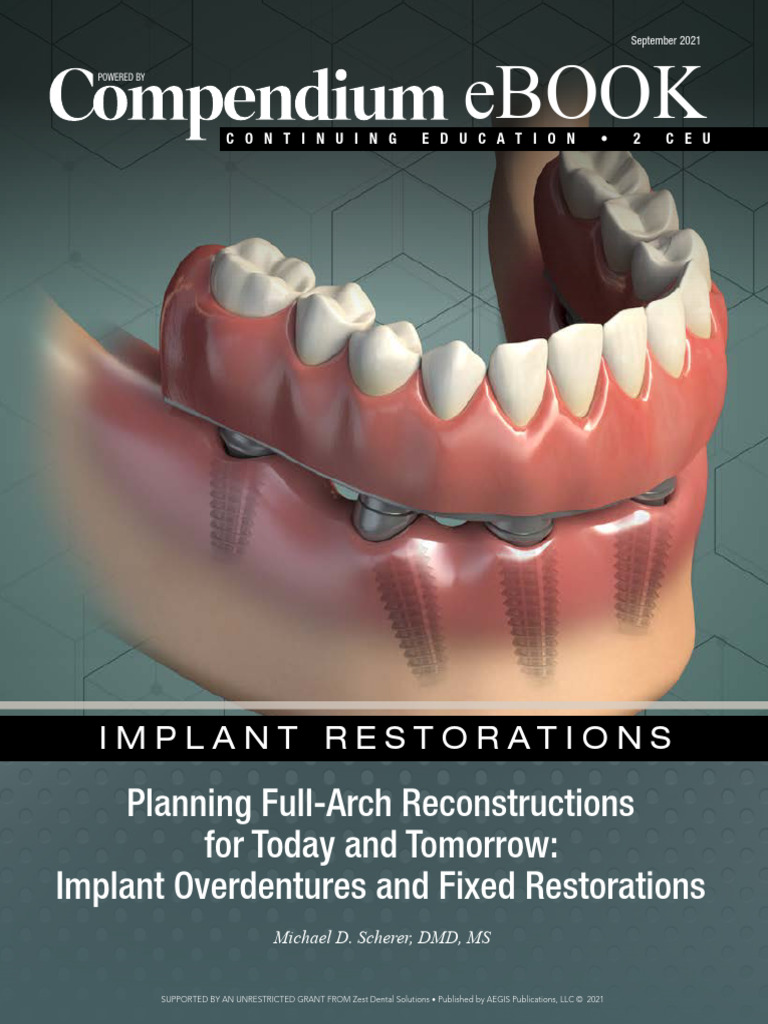 Planning Full Arch Reconstructions For Today and Tomorrow Implant Overdentures and Fixed ...