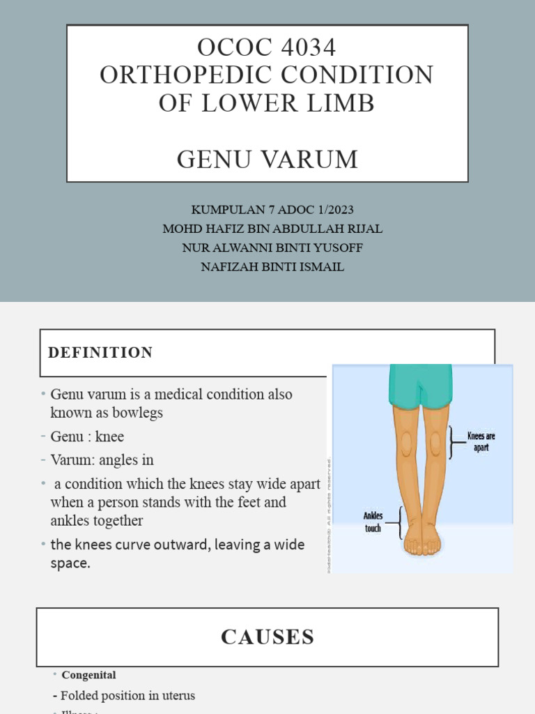 Genu Varum | PDF