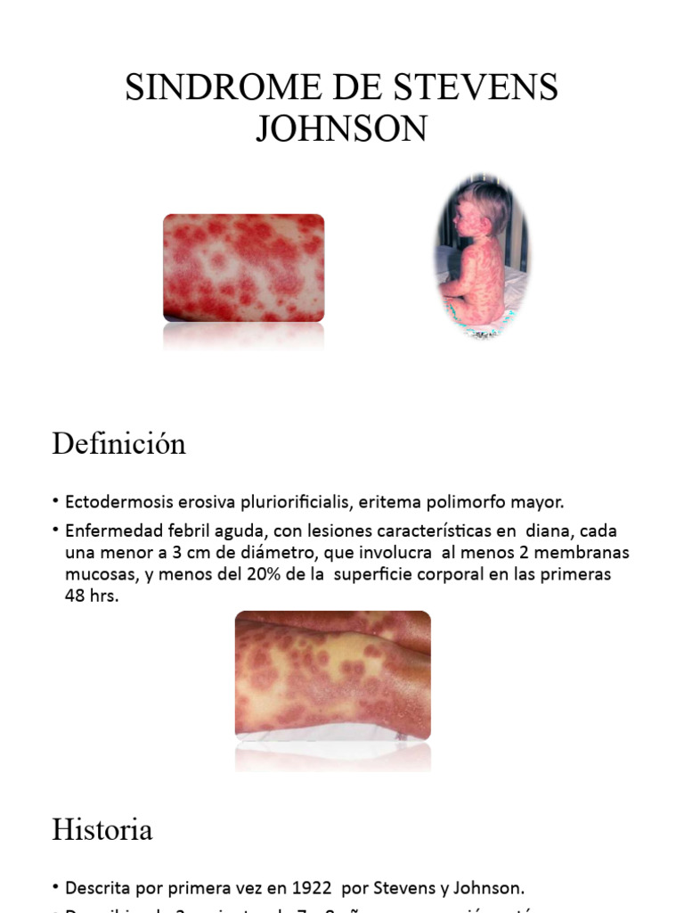 Síndrome de Stevens-Johnson: Causas y Tratamiento | PDF