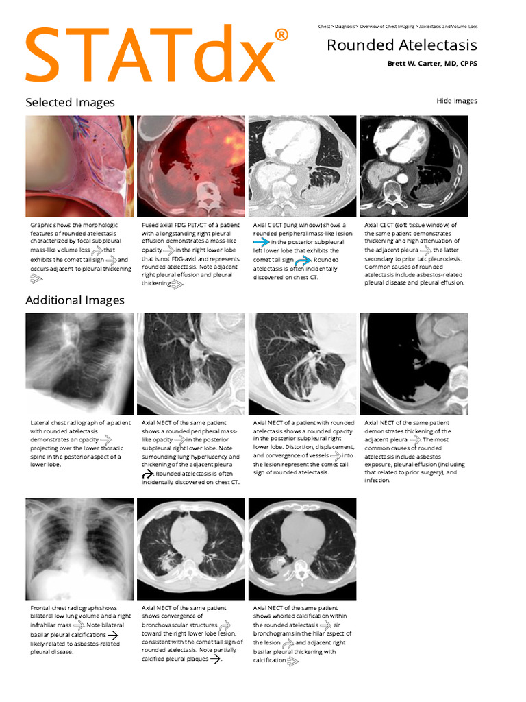 Rounded Atelectasis - Print Friendly - STATdx | PDF | Lung | Ct Scan