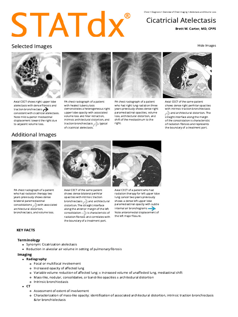 Cicatricial Atelectasis - Print Friendly - STATdx | PDF | Respiratory ...