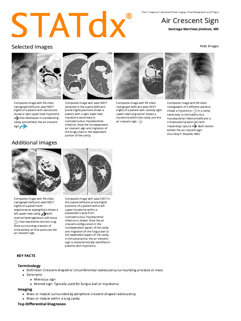 Air Crescent Sign in Chest Imaging | PDF | Clinical Medicine | Medical ...