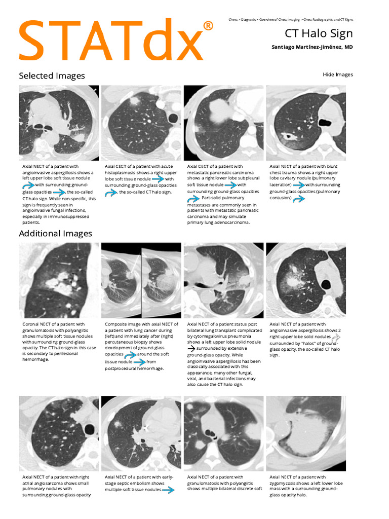 CT Halo Sign - Print Friendly - STATdx | PDF | Causes Of Death | Medical Specialties