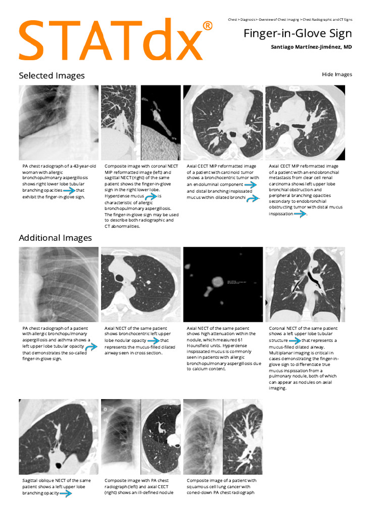 Radiology Insights: Finger-in-Glove Sign | PDF | Lung | Diseases And ...