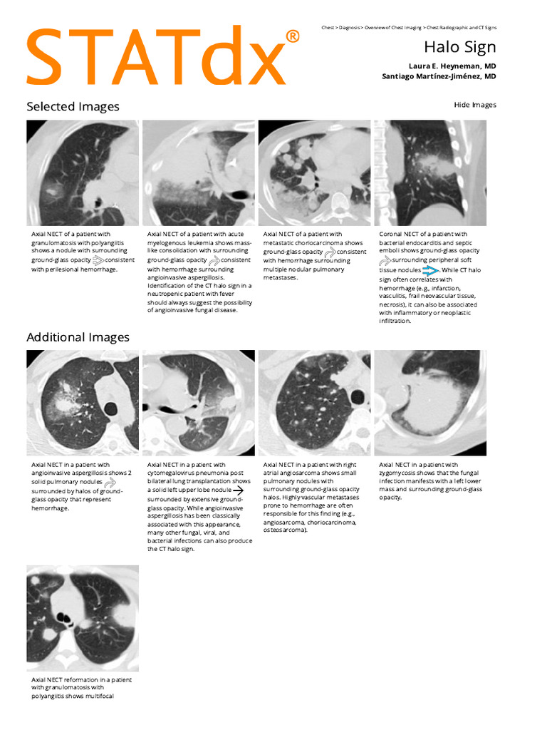 Halo Sign - Print Friendly - STATdx | PDF | Diseases And Disorders | Clinical Medicine