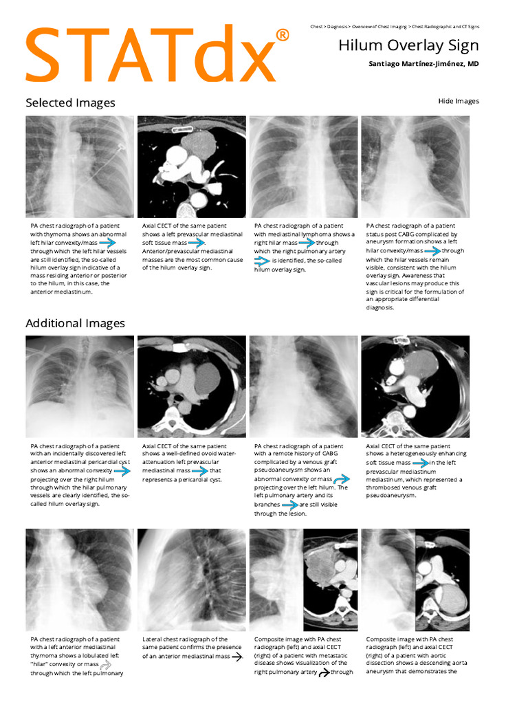 Hilum Overlay Sign in Chest Imaging | PDF