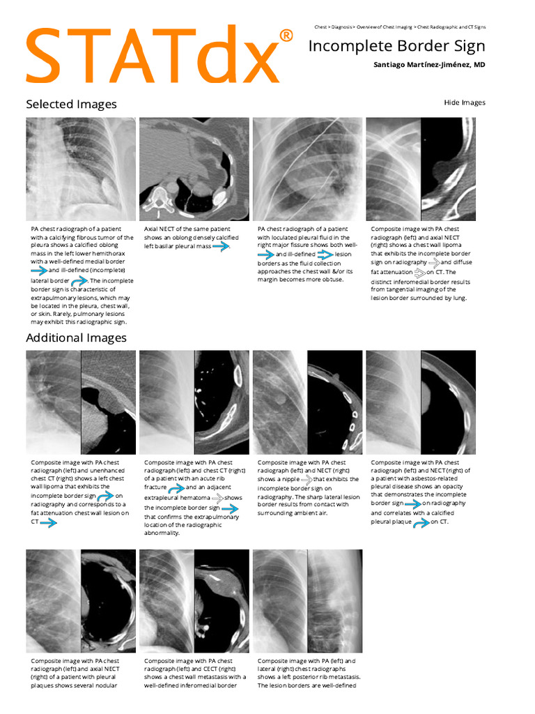 Incomplete Border Sign - Print Friendly _ STATdx | PDF | Radiography ...