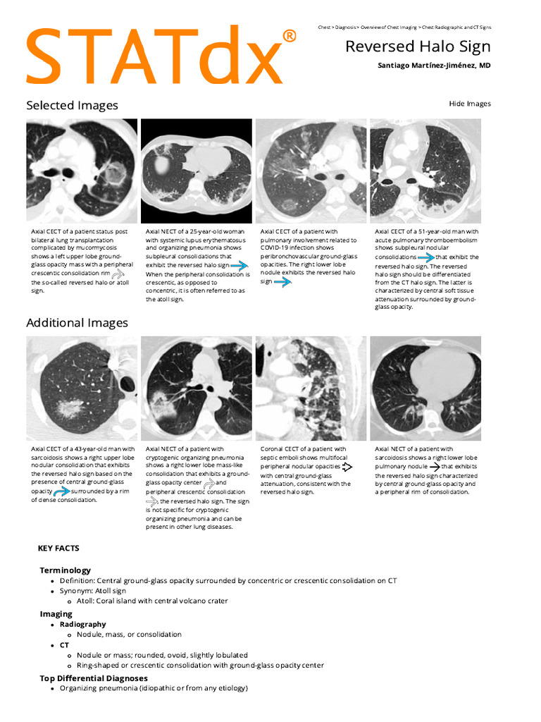 Reversed Halo Sign in Chest Imaging | PDF