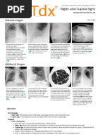 Hilum Overlay Sign in Chest Imaging | PDF