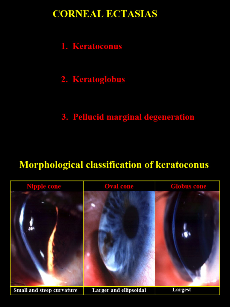 Keratoconus vs Pellucid Marginal Degeneration | PDF