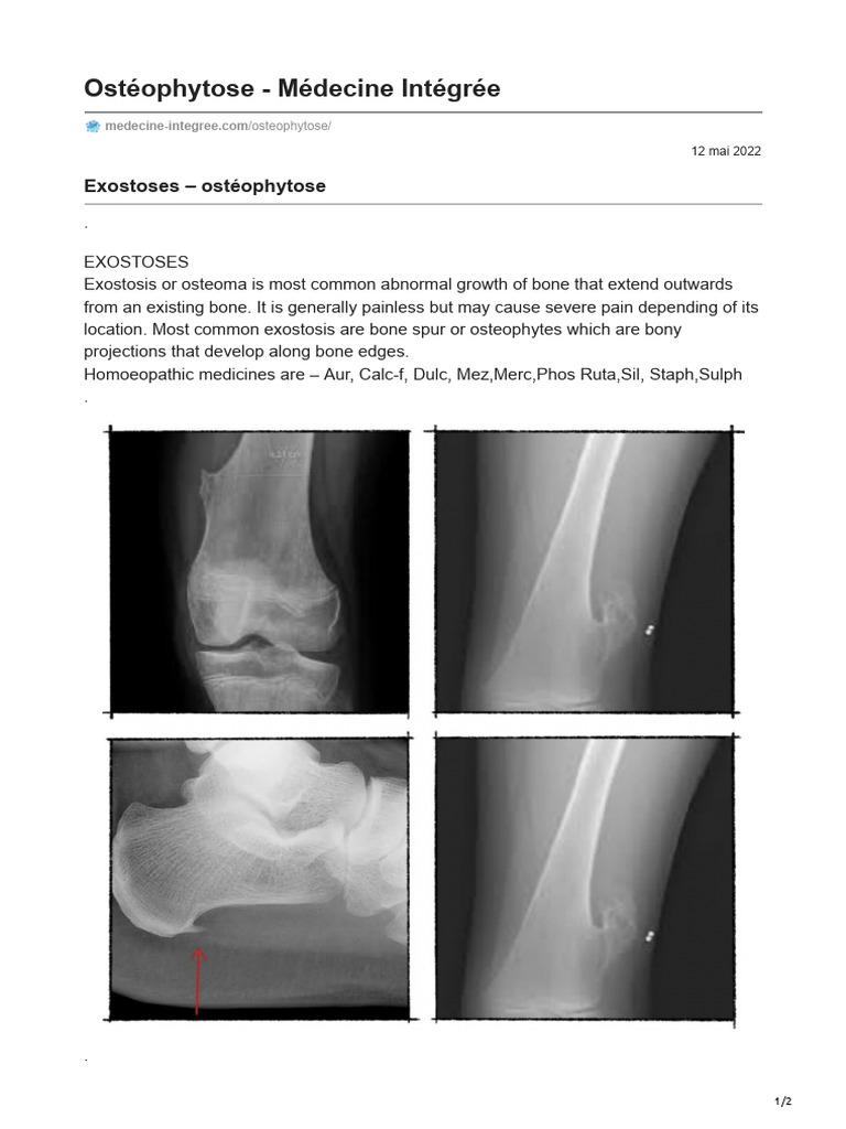 Homoeopathy for Bone Spurs | PDF | Toe | Bone