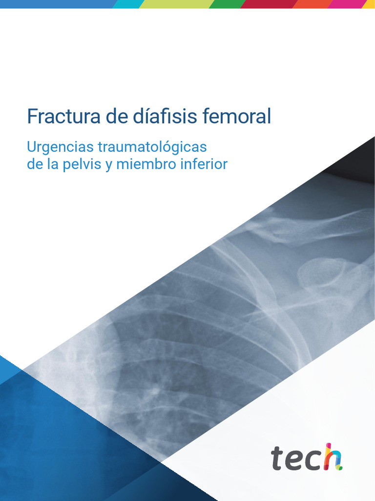 Traumatologia I Fractura de Díafisis Femoral | PDF | Lesión | Sistema ...