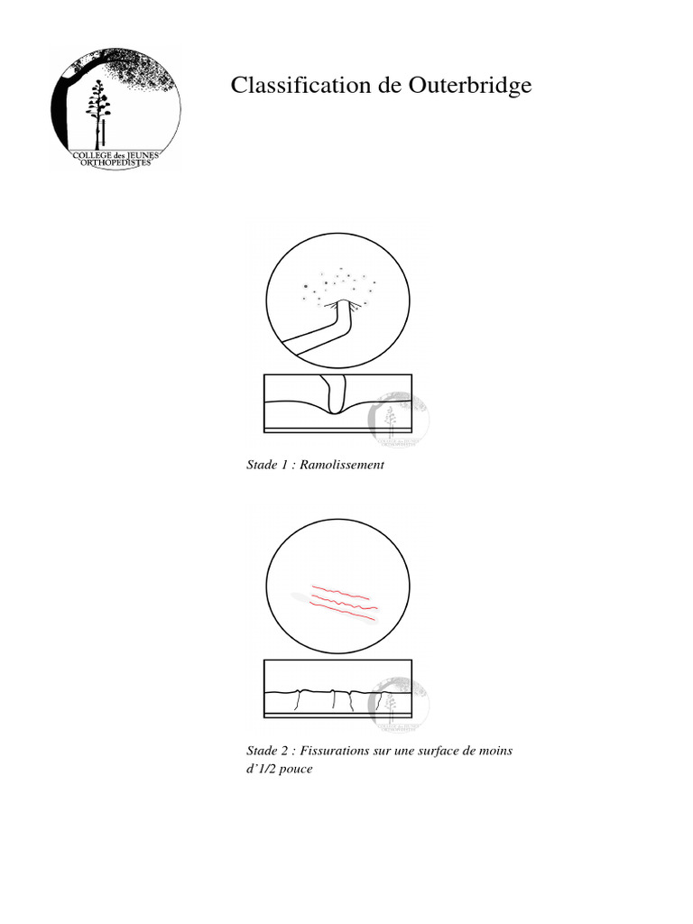 Classification de Outerbridge des lésions articulaires | PDF | Sports ...