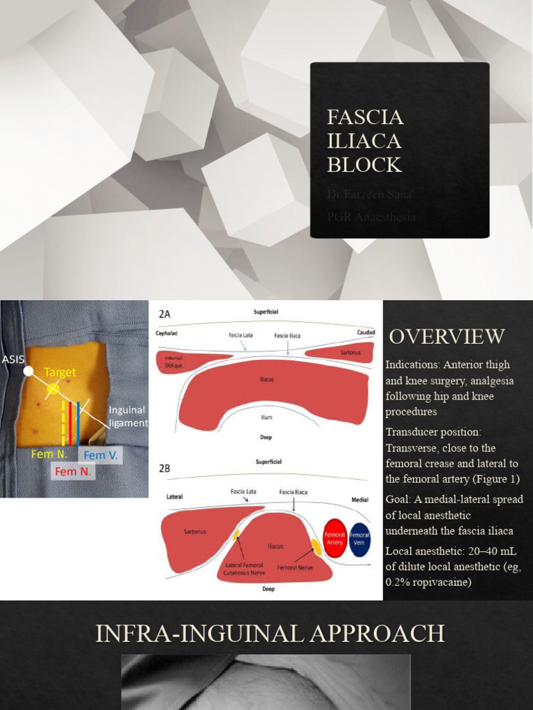 Fascia Iliaca Block Overview Guide | PDF | Science & Mathematics