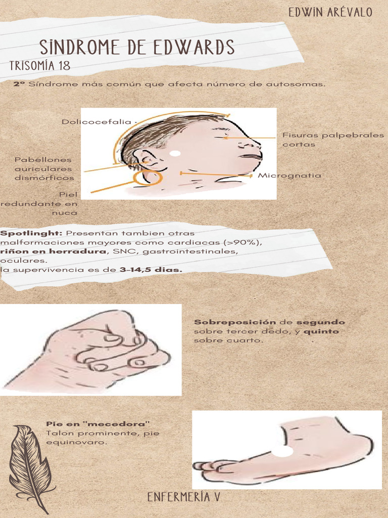 Sindrome de Edwards, Trisomia 18 | PDF