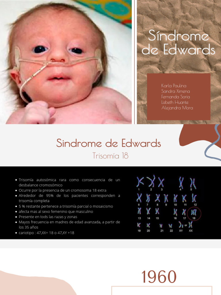 Síndrome de Edwards | PDF