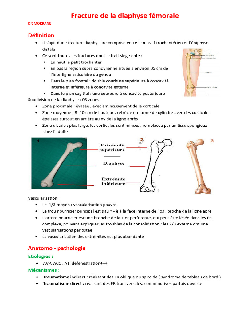 Fracture diaphysaire du fémur | PDF