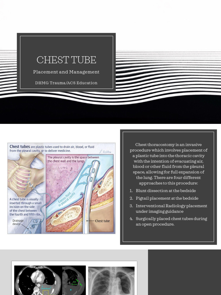Chest Tube | PDF | Thorax | Clinical Medicine