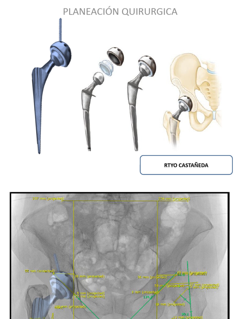 Cerclaje tipo obenque en cirugía ortopédica | PDF