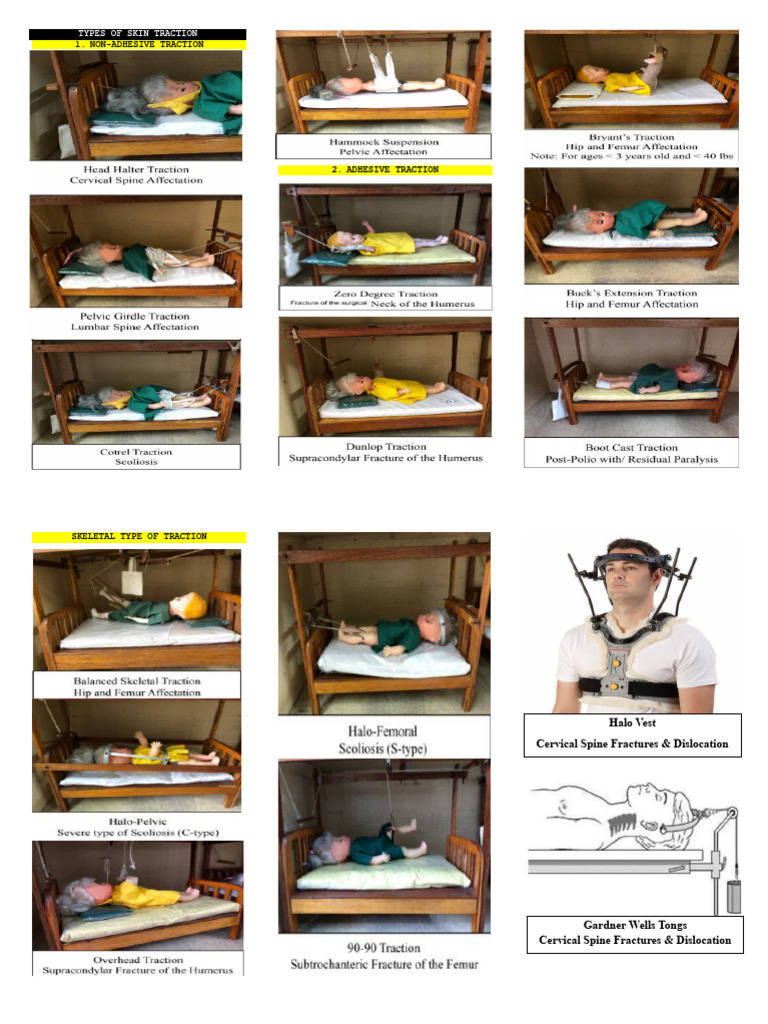 Tractions and Casts | PDF