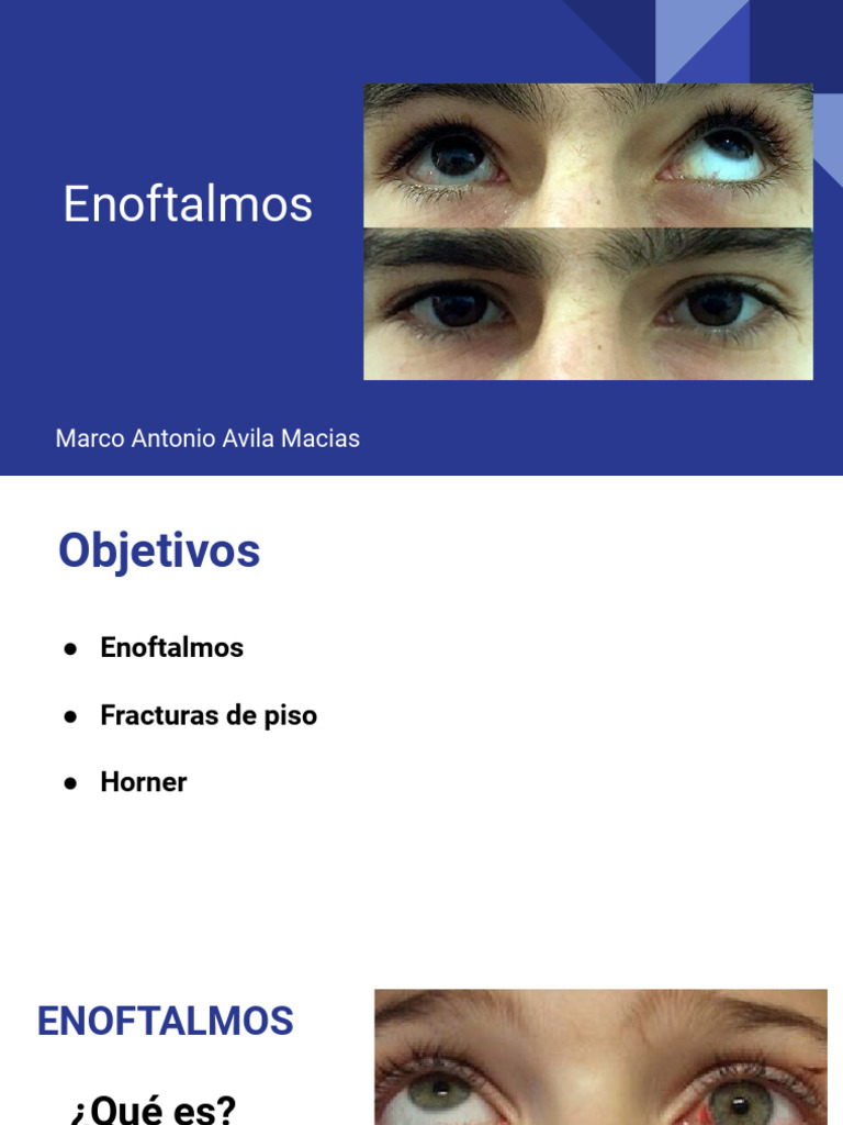 6 Enoftalmos | PDF