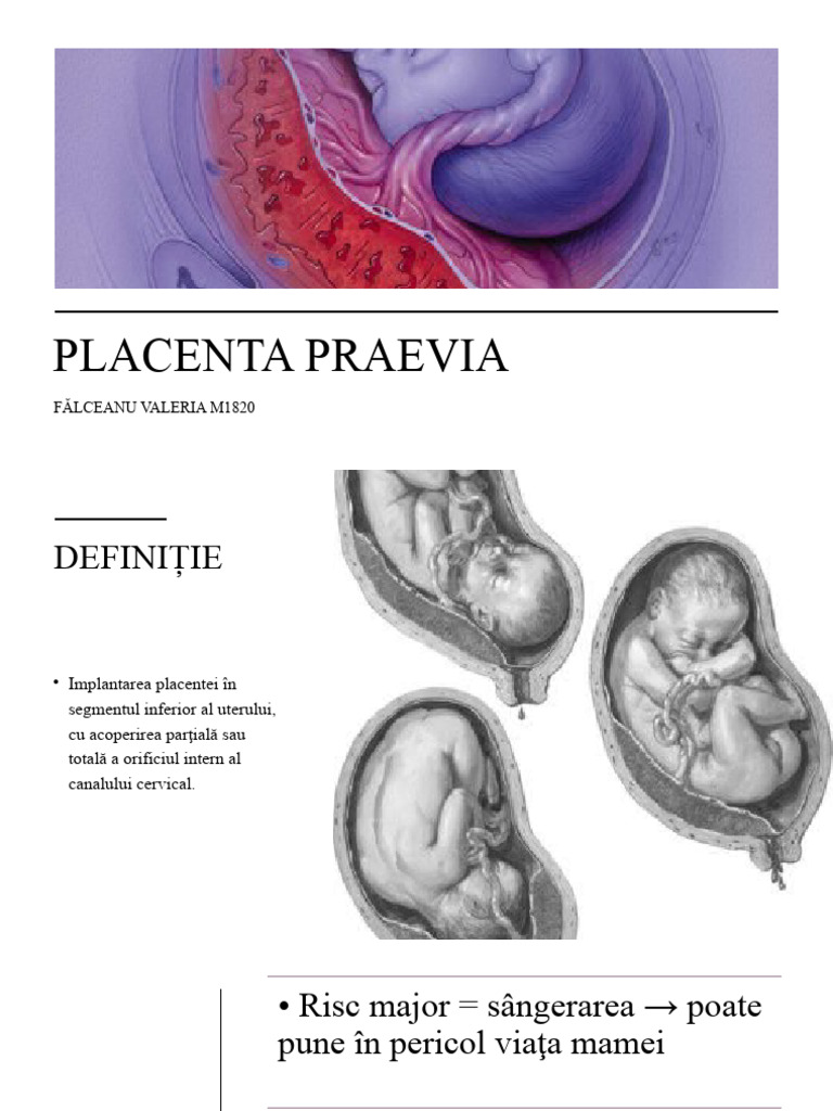 Placenta Pravia | PDF
