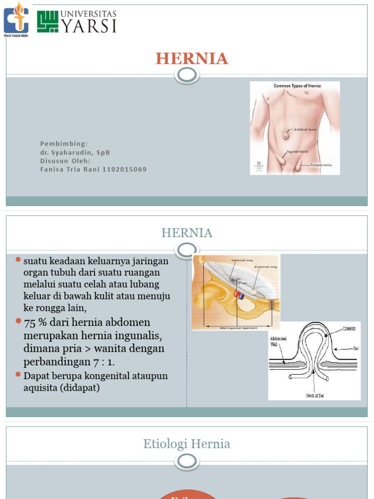Hernia | PDF