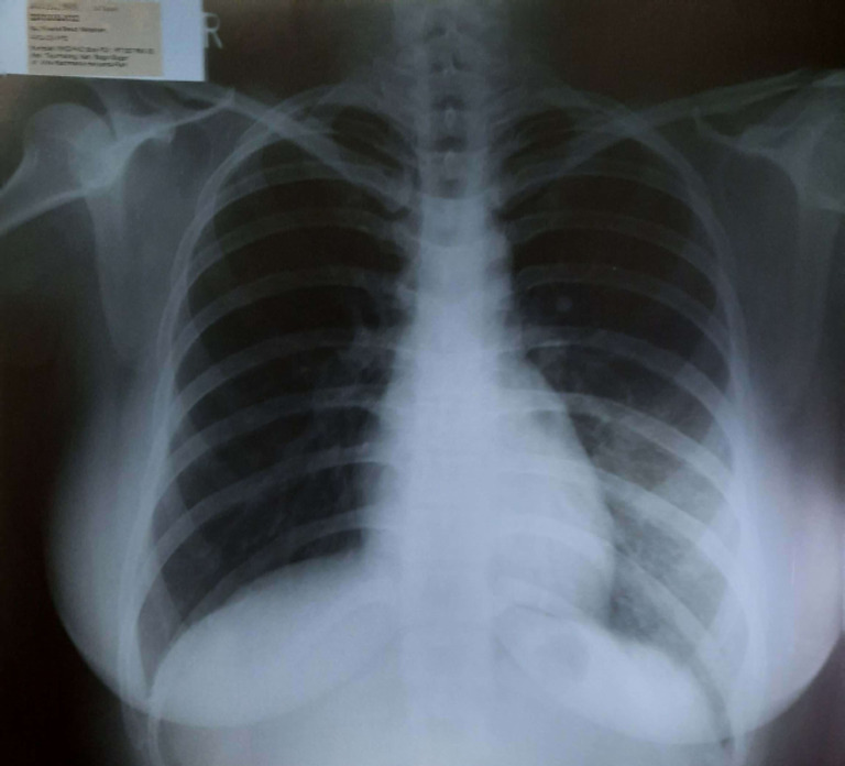 Rontgen Thorax_1 | PDF