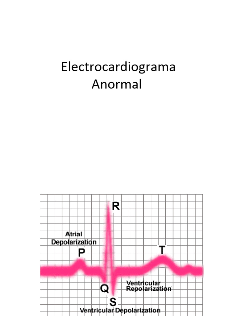 ECG anormal2 | PDF | Electrocardiografia | Arritmia cardiaca