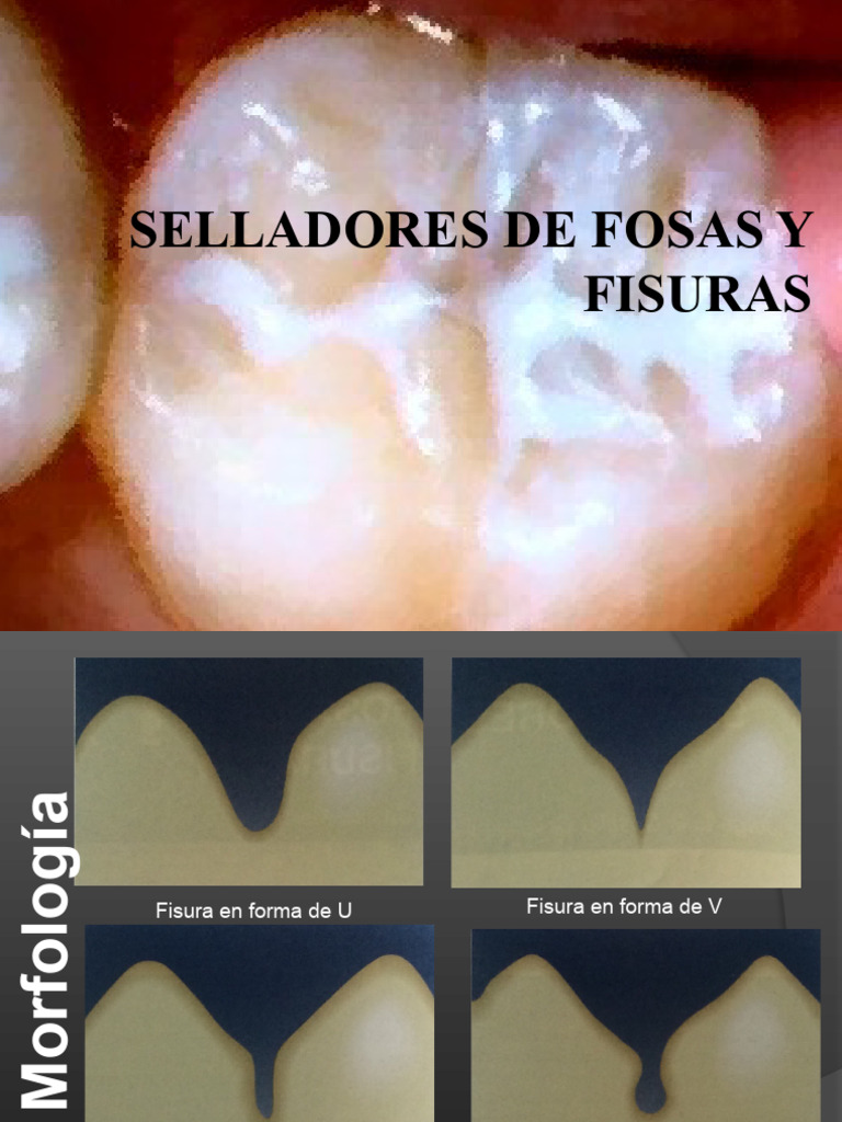Selladores de Fosetas y Fisuras Dentales | PDF