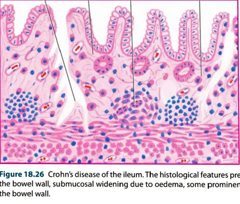 Histology Crohns | PDF