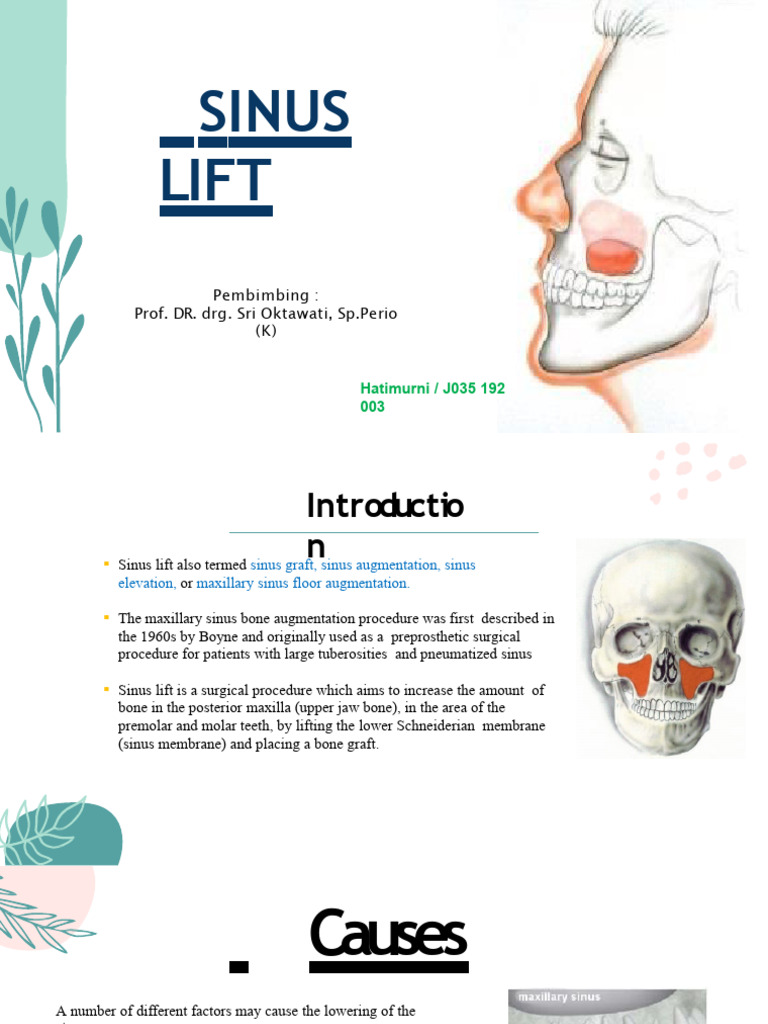 Sinus Lift - 21 Des 2021 | PDF