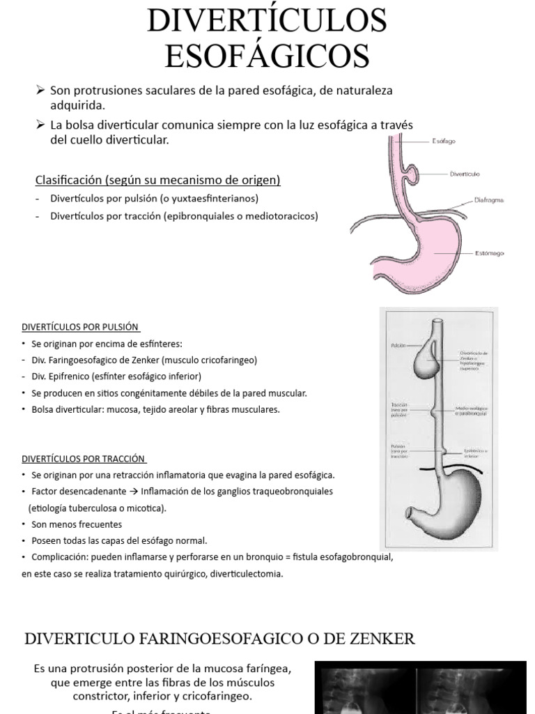 Divertículos Esofágicos | PDF