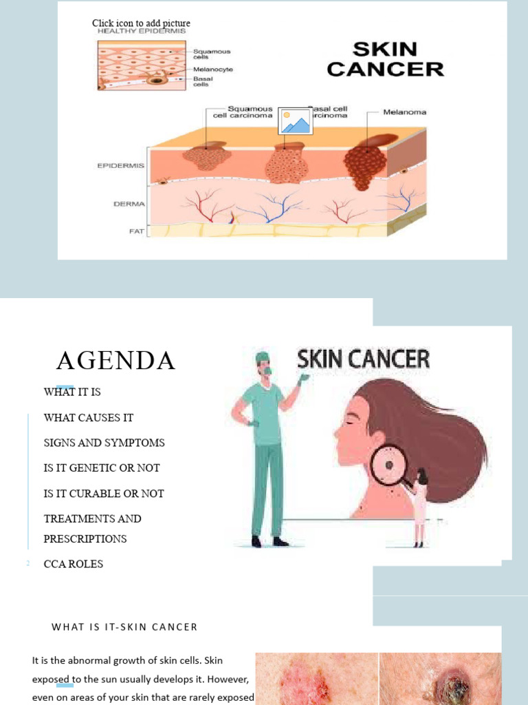 SKIN CANCER | PDF