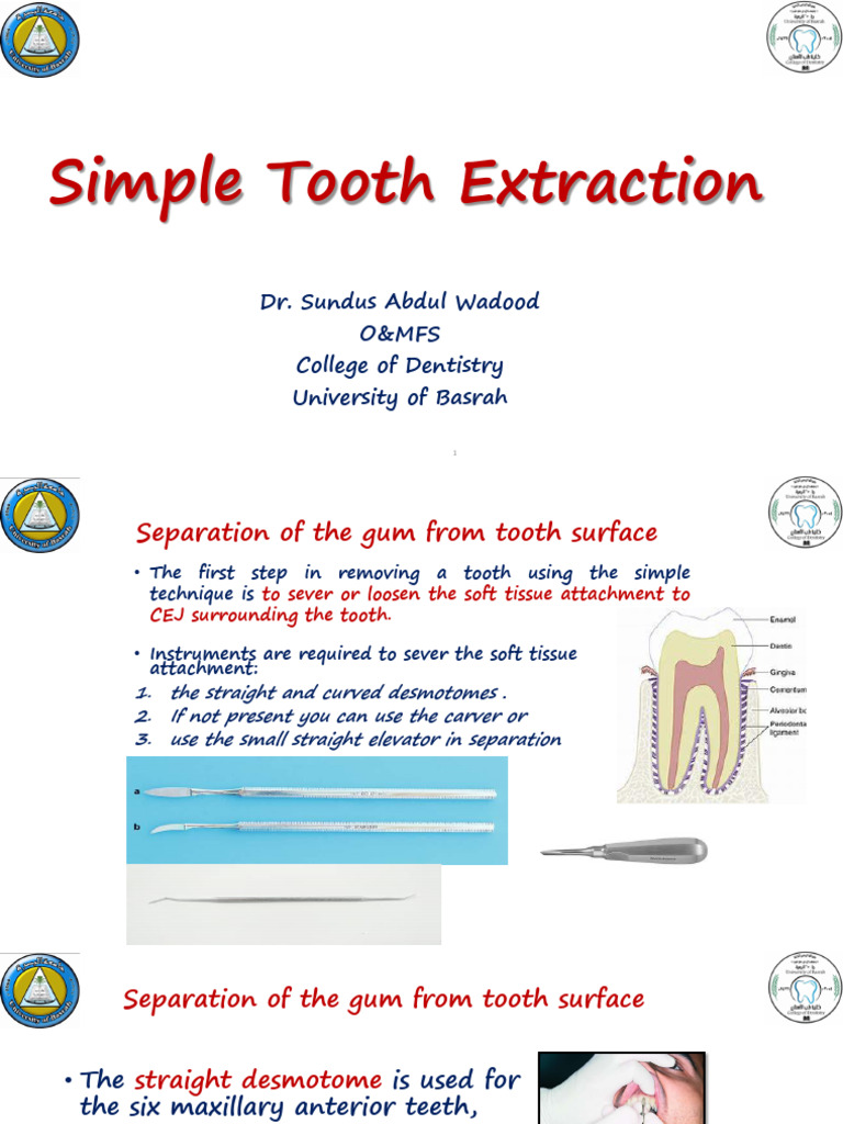 Simple Tooth Extraction Guide | PDF