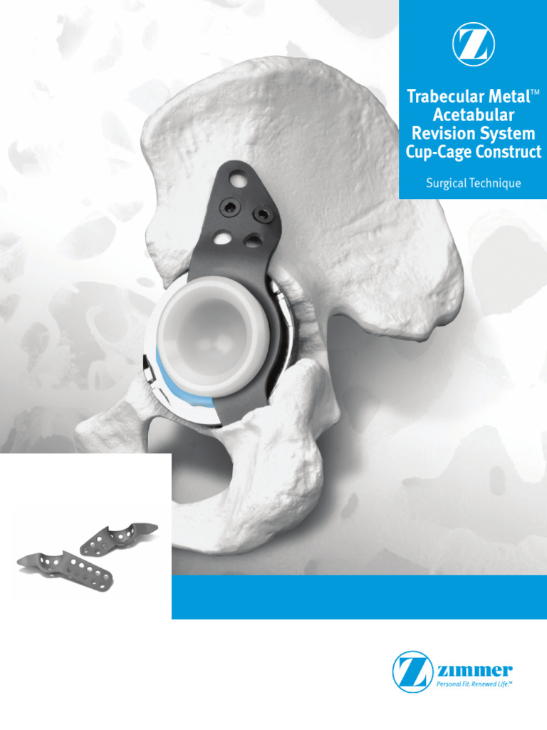 Zimmer Trabecular Metal Acetabular Revision System Cup Cage Construct 2 ...