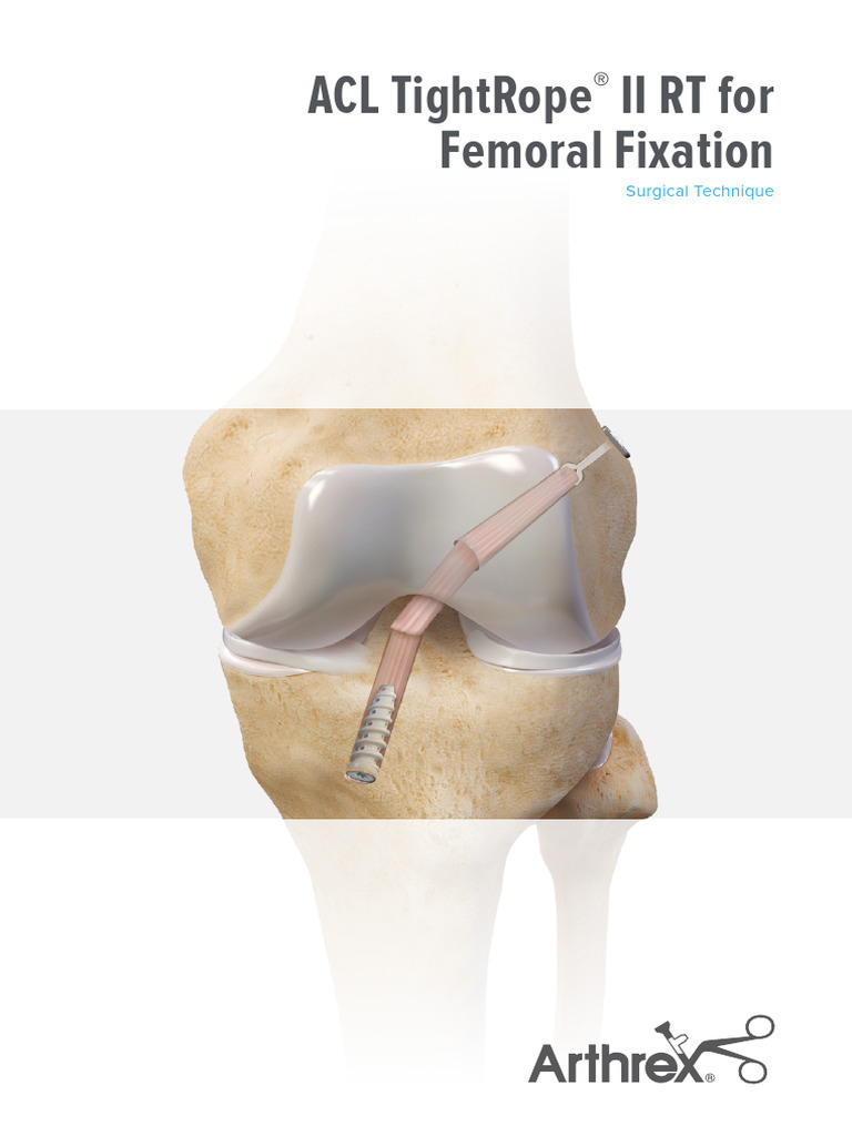 Acl Tightrope II RT For Femoral Fixation | PDF