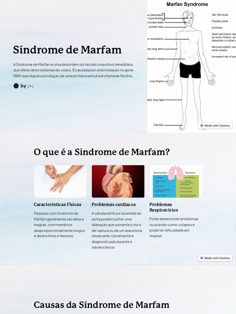 Sindrome de Marfam | PDF