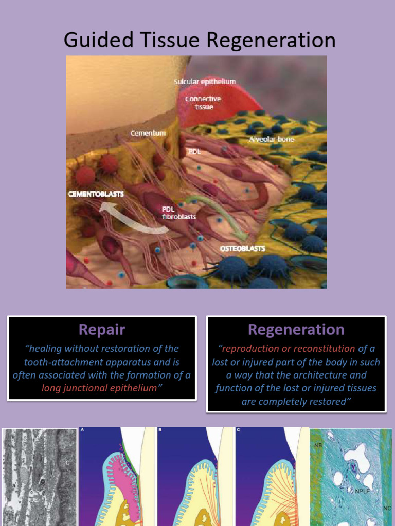 Guided Tissue Regeneration | PDF | Periodontology | Surgical Suture