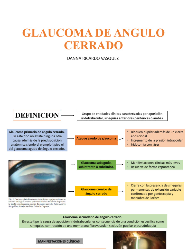 Glaucoma de Angulo Cerrado | PDF