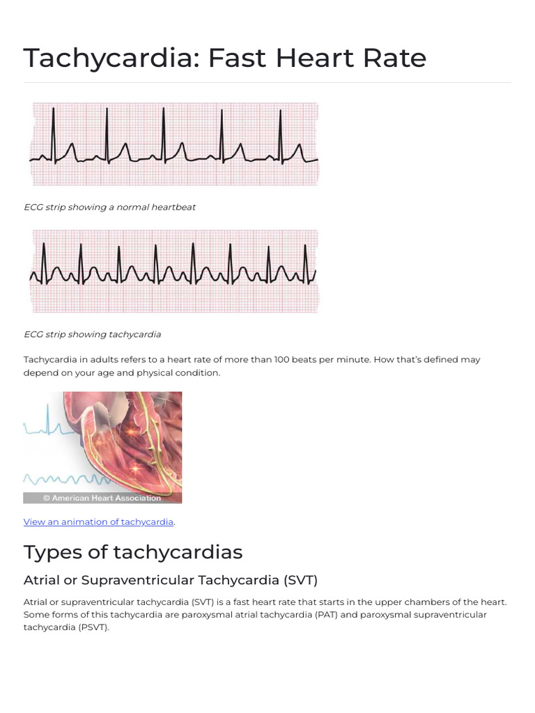 Tachycardia: Fast Heart Rate - American Heart Ass | PDF