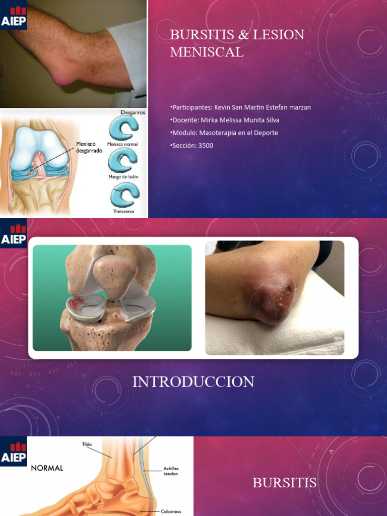 Bursitis y Lesion Meniscal | PDF | Rodilla | Hombro
