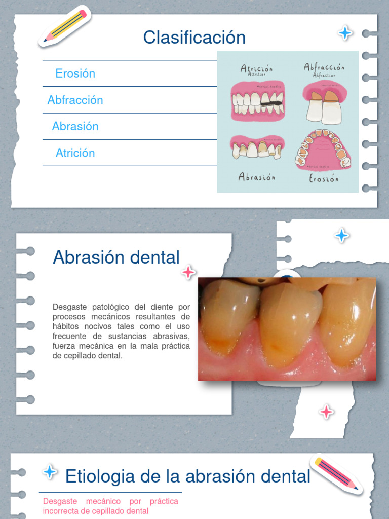 Abrasion, Abfrasion y Erosion | Descargar gratis PDF | Esmalte de ...